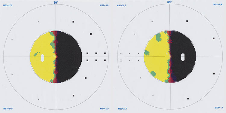 Quadrantenanopsie Oben Stereotaktische Laserablation | Clinical